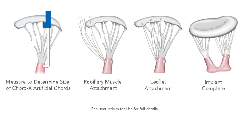 Chord-X Procedural Overview - CryoLife, Inc.